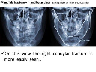 Anatomy and image interpretation of facial bone | PPTX