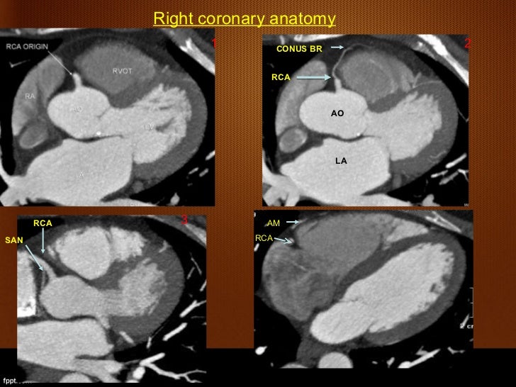 coronary angiogram 계속 : 네이버 블로그