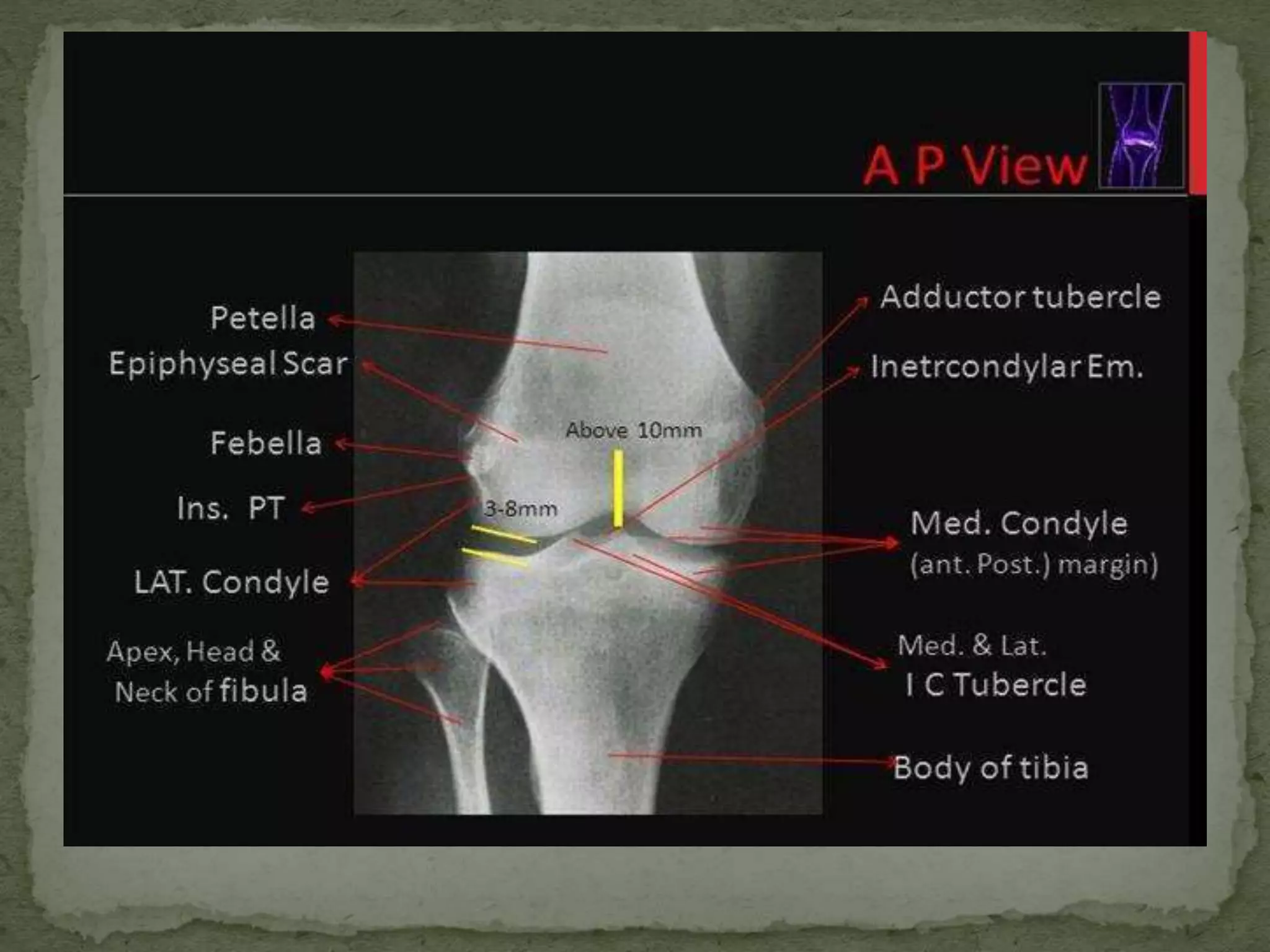 Anatomy and imaging of knee joint | PPTX