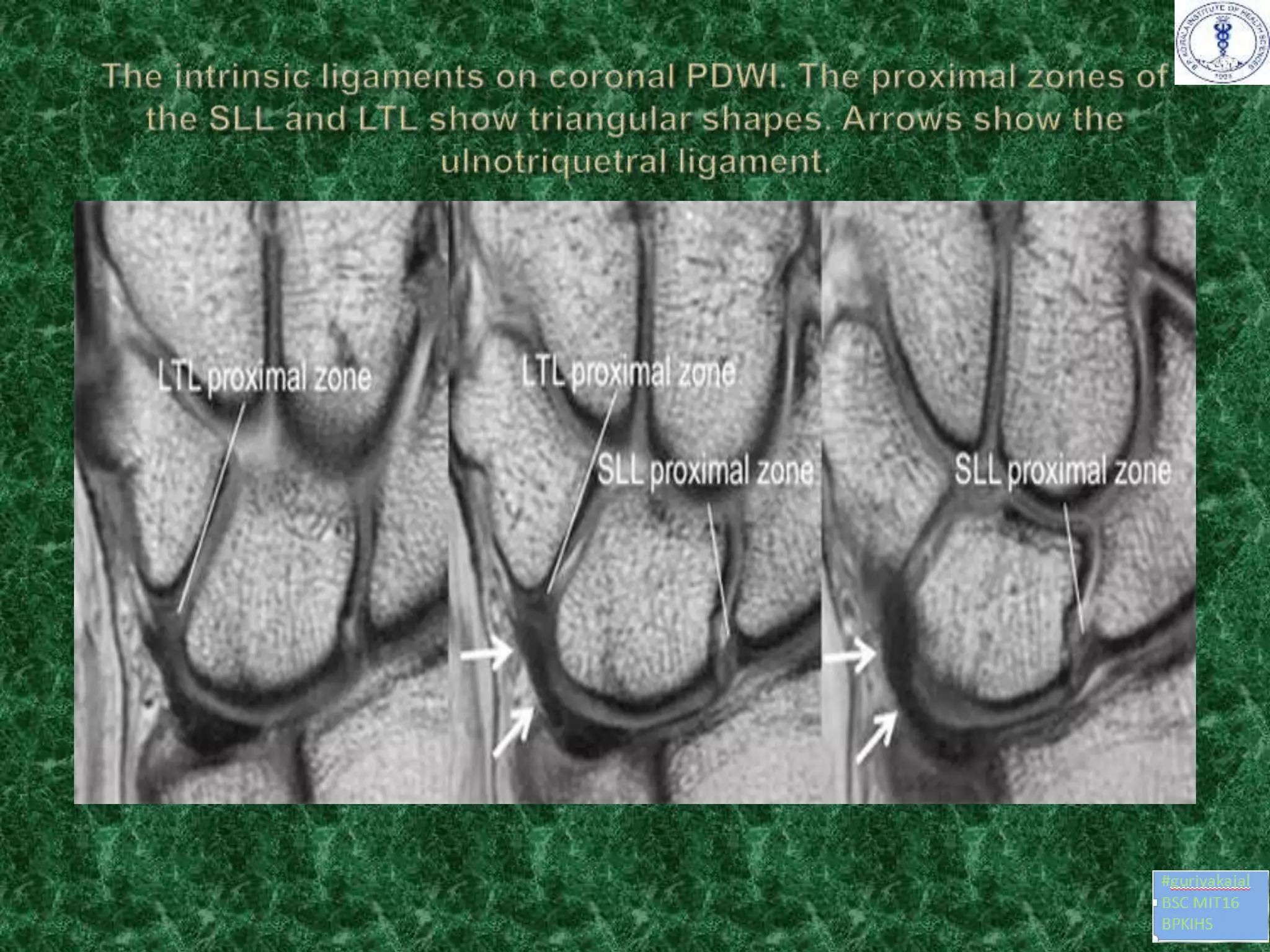 Anatomy and imaging of wrist joint (MRI AND XRAY) | PPTX