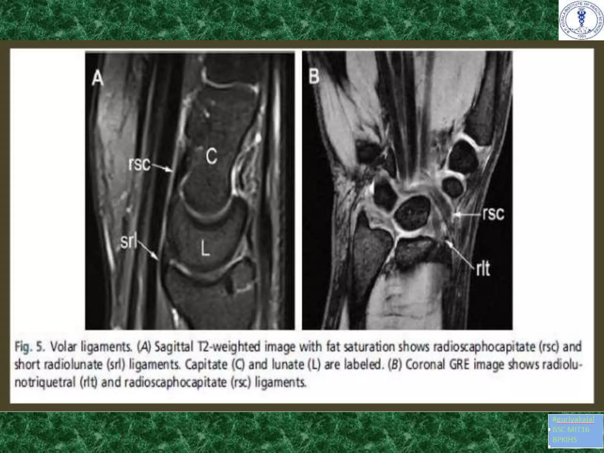 Anatomy and imaging of wrist joint (MRI AND XRAY) | PPTX