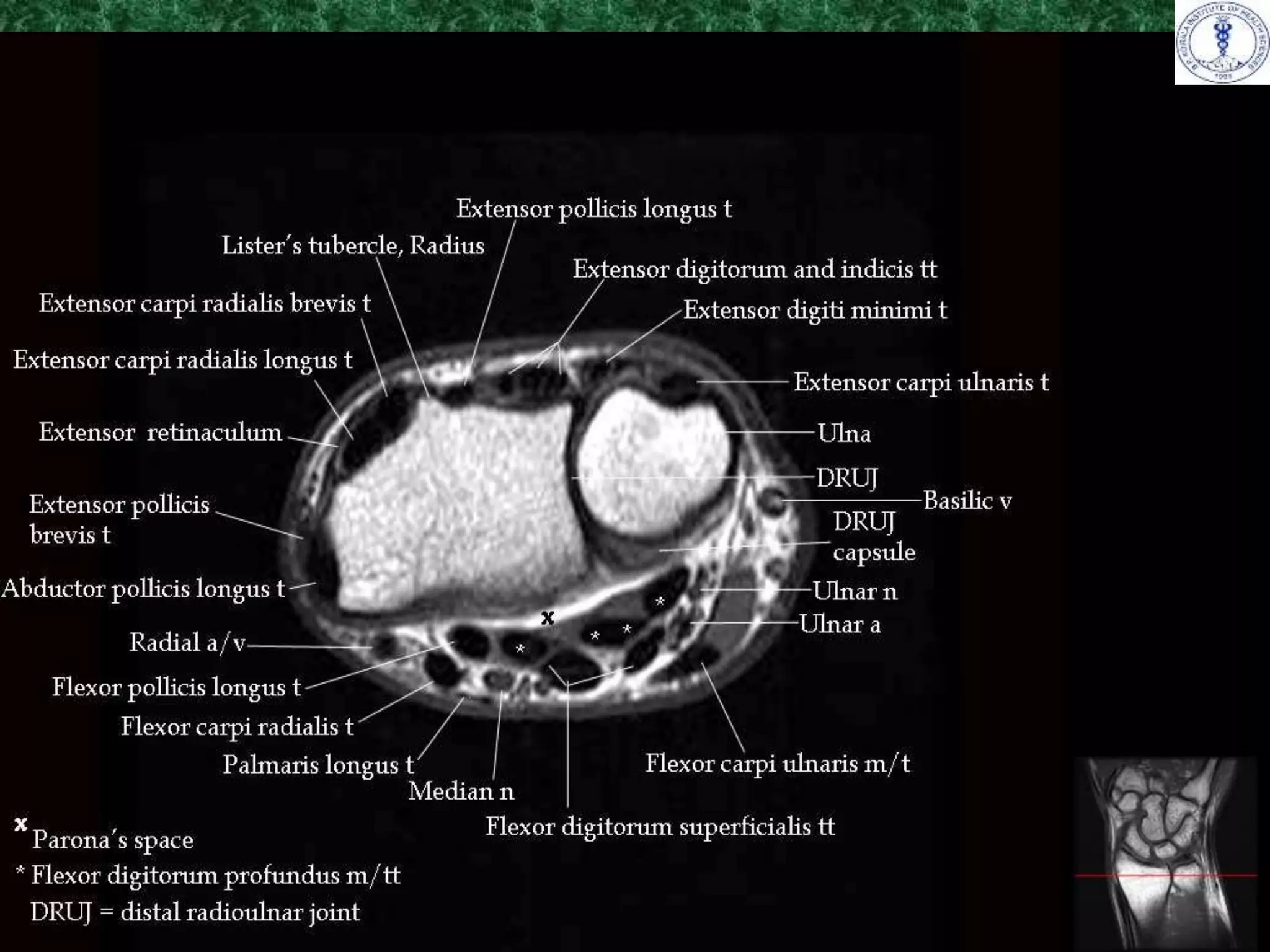 Anatomy and imaging of wrist joint (MRI AND XRAY) | PPTX