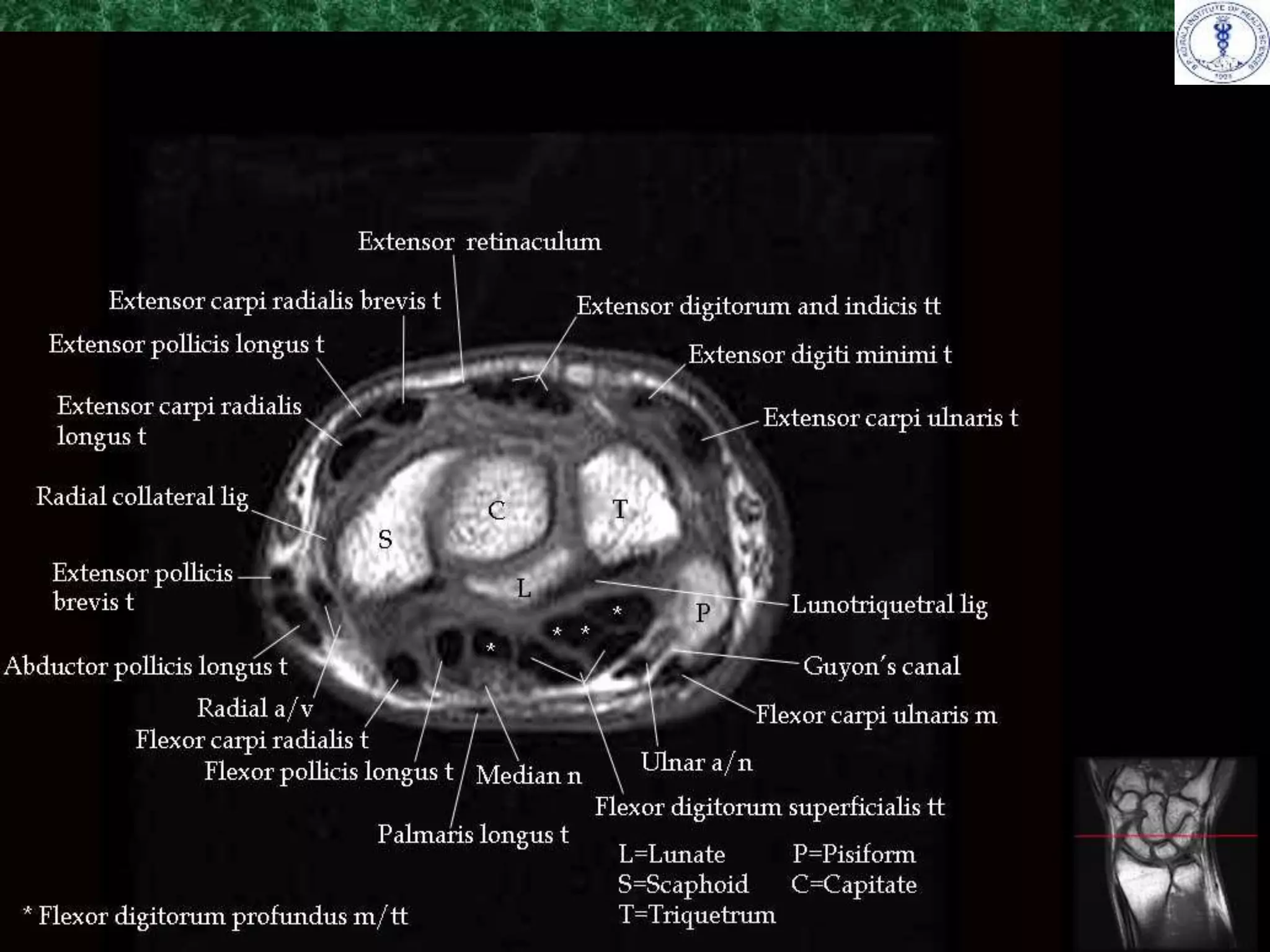Anatomy and imaging of wrist joint (MRI AND XRAY) | PPTX