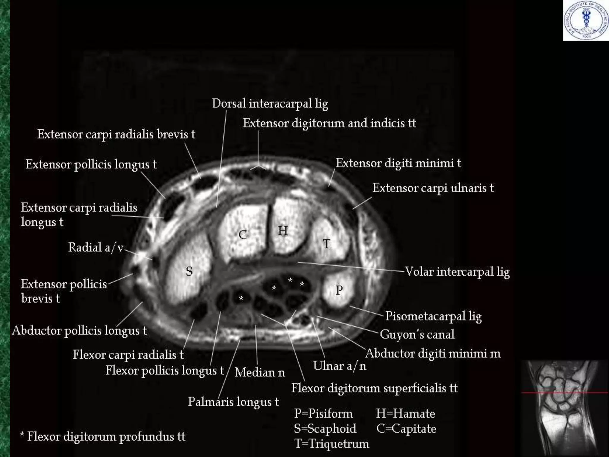 Anatomy and imaging of wrist joint (MRI AND XRAY) | PPTX