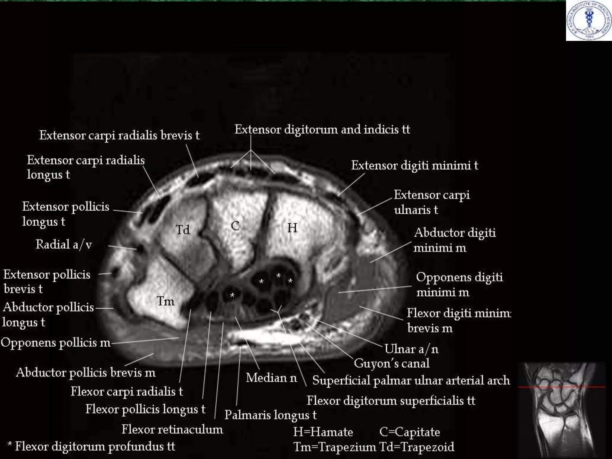 Anatomy and imaging of wrist joint (MRI AND XRAY) | PPTX