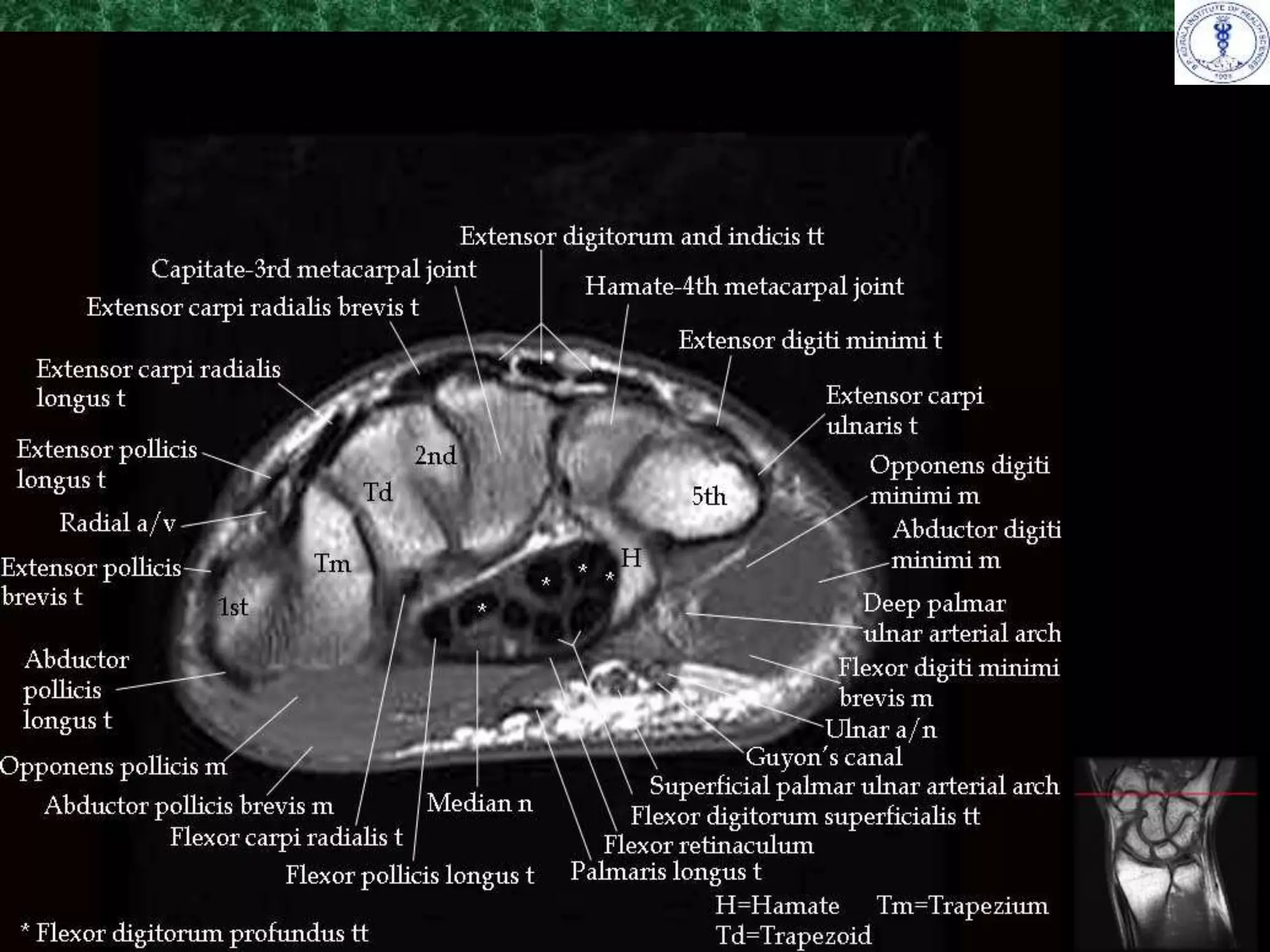 Anatomy and imaging of wrist joint (MRI AND XRAY) | PPTX