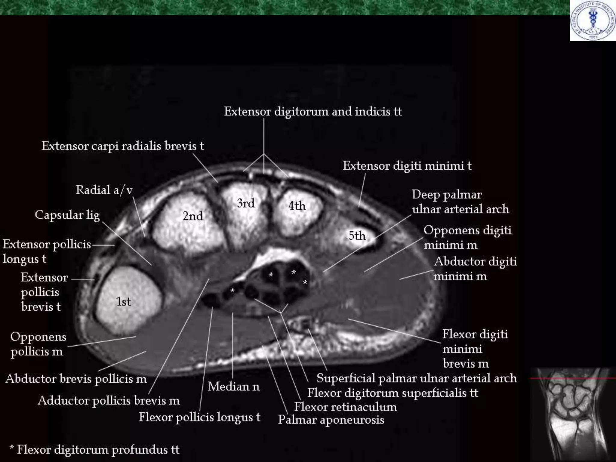 Anatomy and imaging of wrist joint (MRI AND XRAY) | PPTX