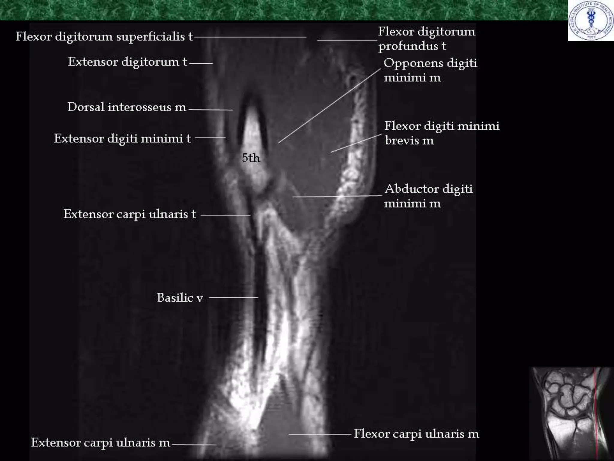 Anatomy and imaging of wrist joint (MRI AND XRAY) | PPTX
