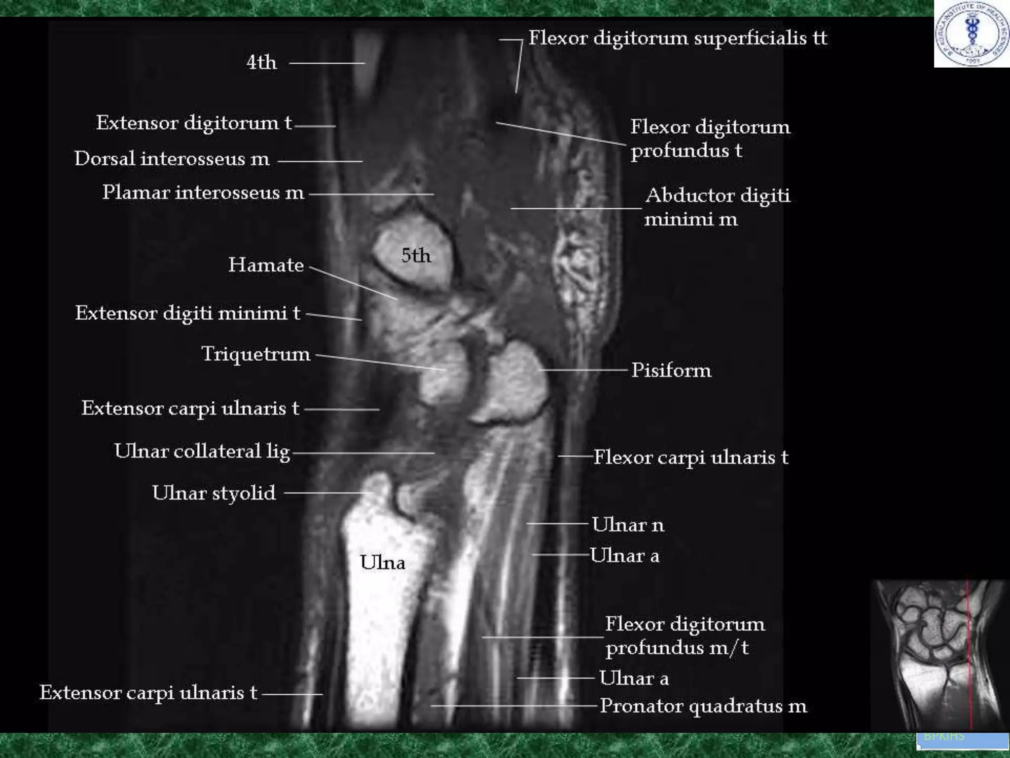 Anatomy and imaging of wrist joint (MRI AND XRAY) | PPTX