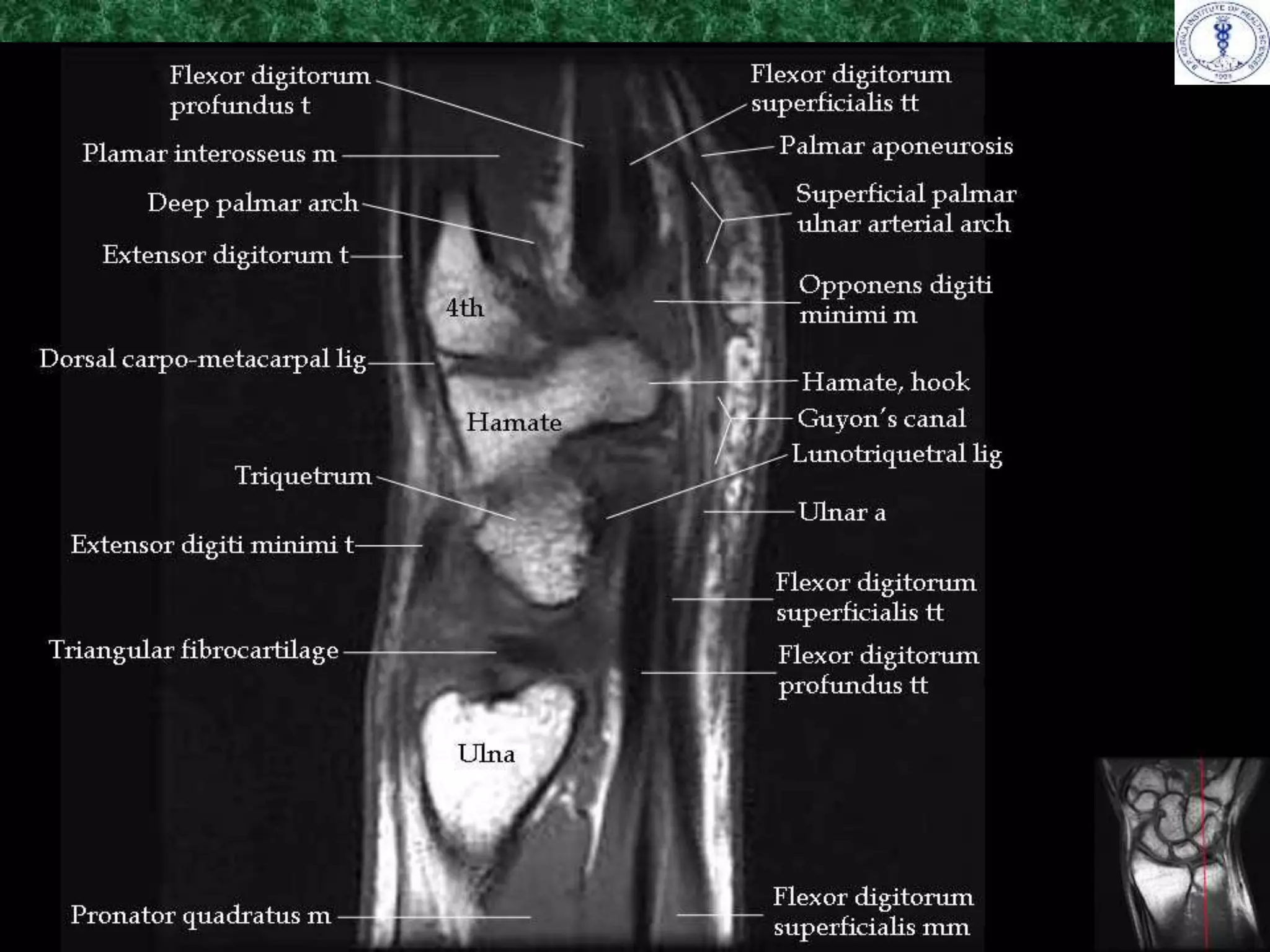 Anatomy and imaging of wrist joint (MRI AND XRAY) | PPTX