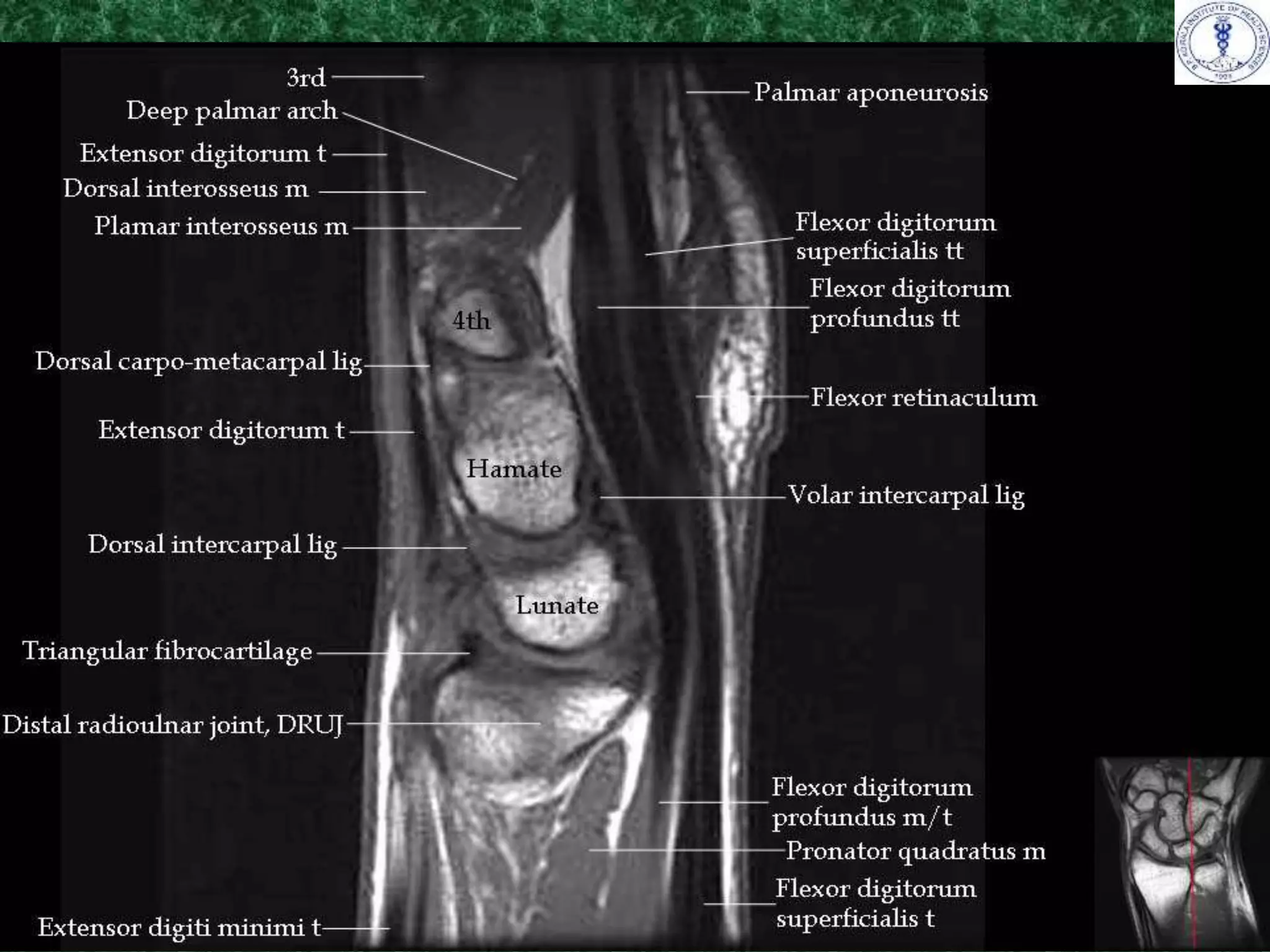 Anatomy and imaging of wrist joint (MRI AND XRAY) | PPTX