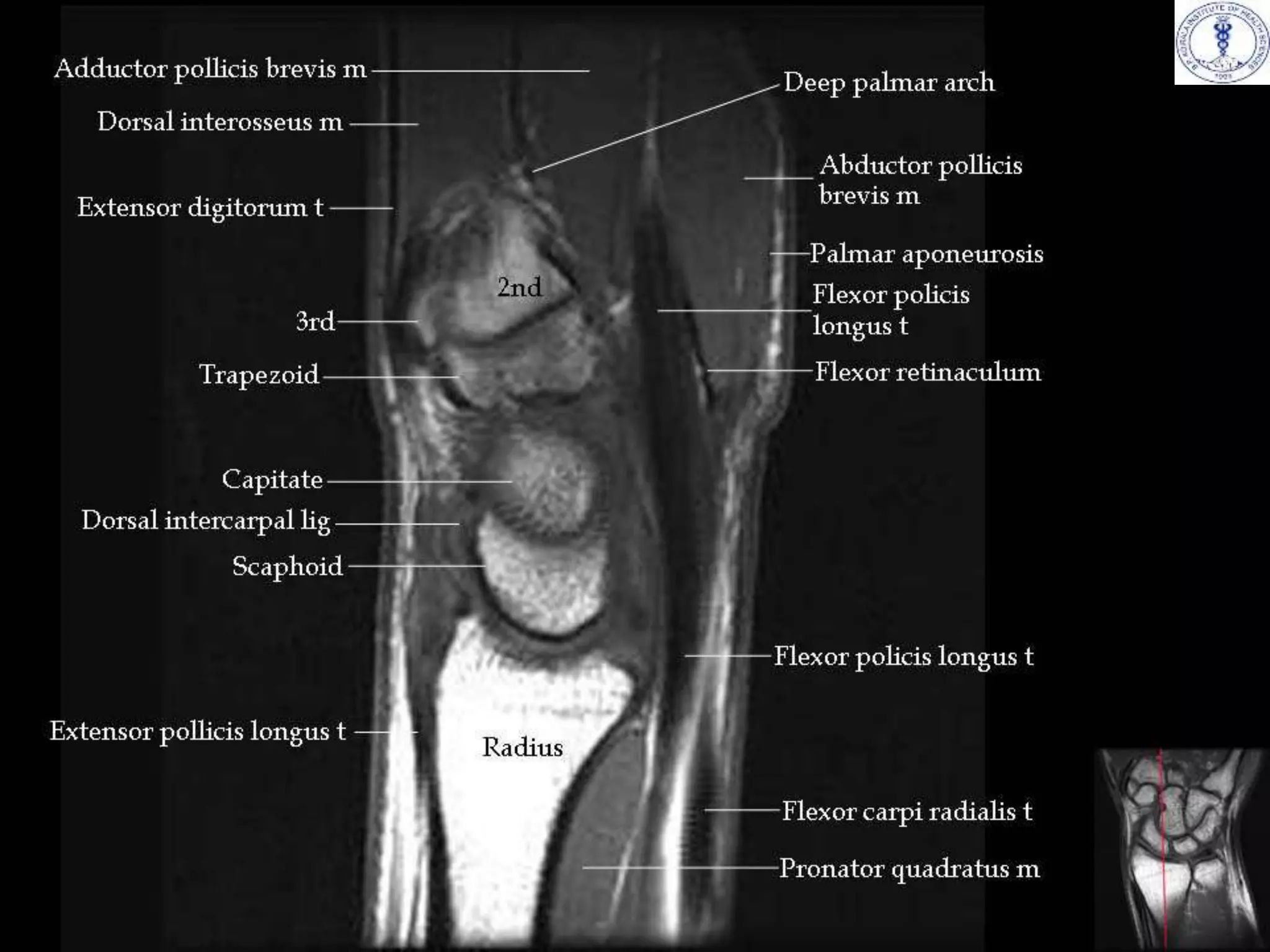 Anatomy and imaging of wrist joint (MRI AND XRAY) | PPTX