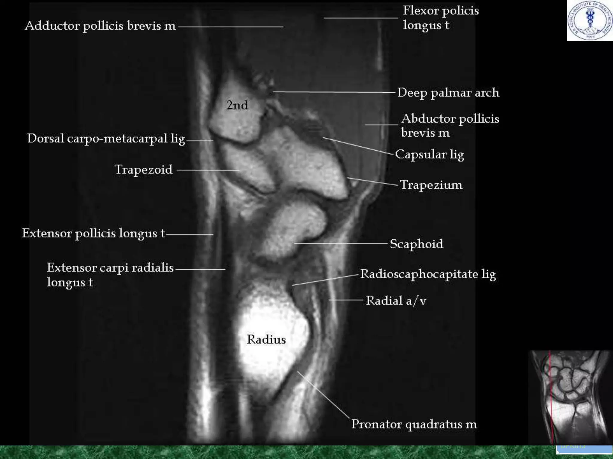Anatomy and imaging of wrist joint (MRI AND XRAY) | PPTX