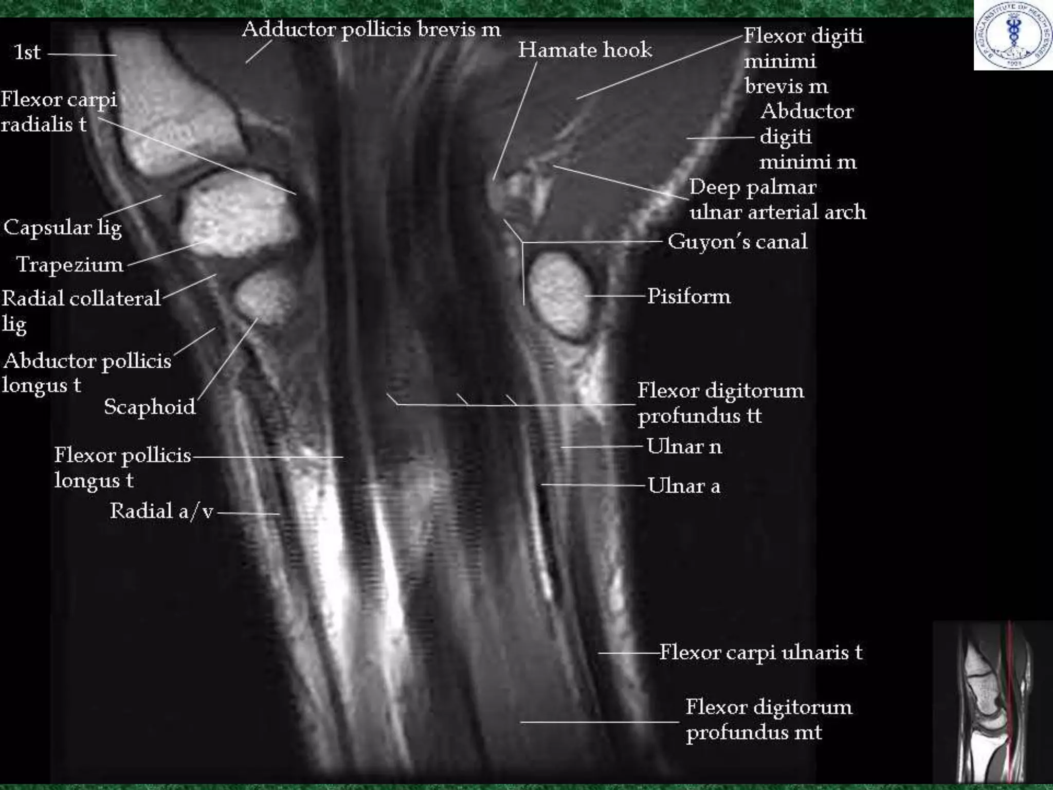 Anatomy and imaging of wrist joint (MRI AND XRAY) | PPTX