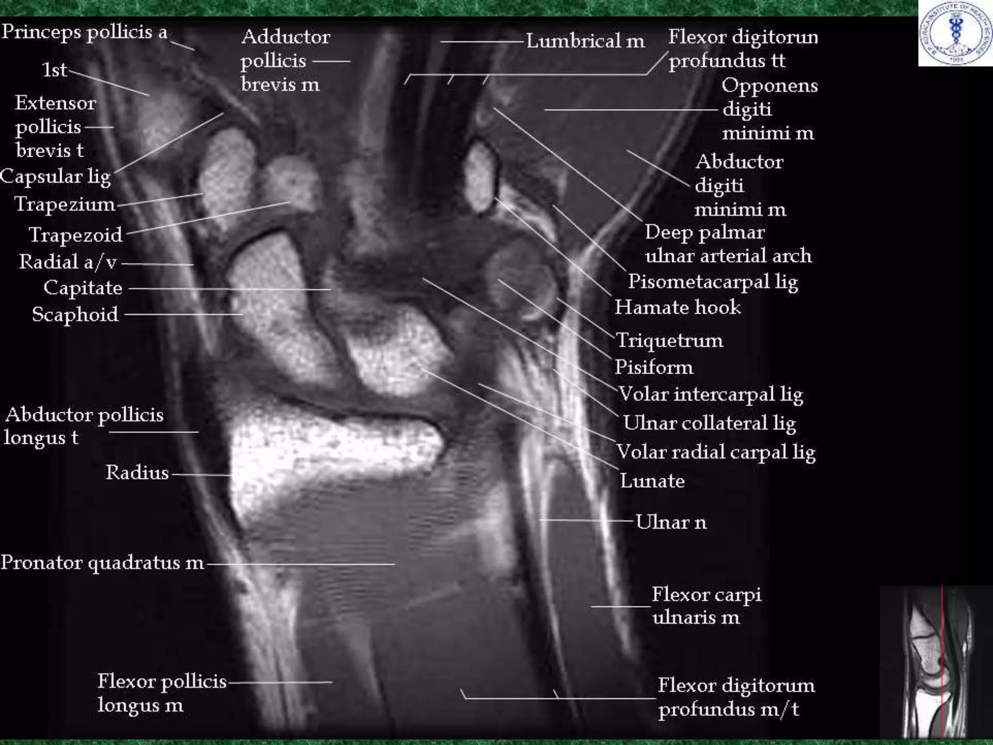 Anatomy and imaging of wrist joint (MRI AND XRAY) | PPTX
