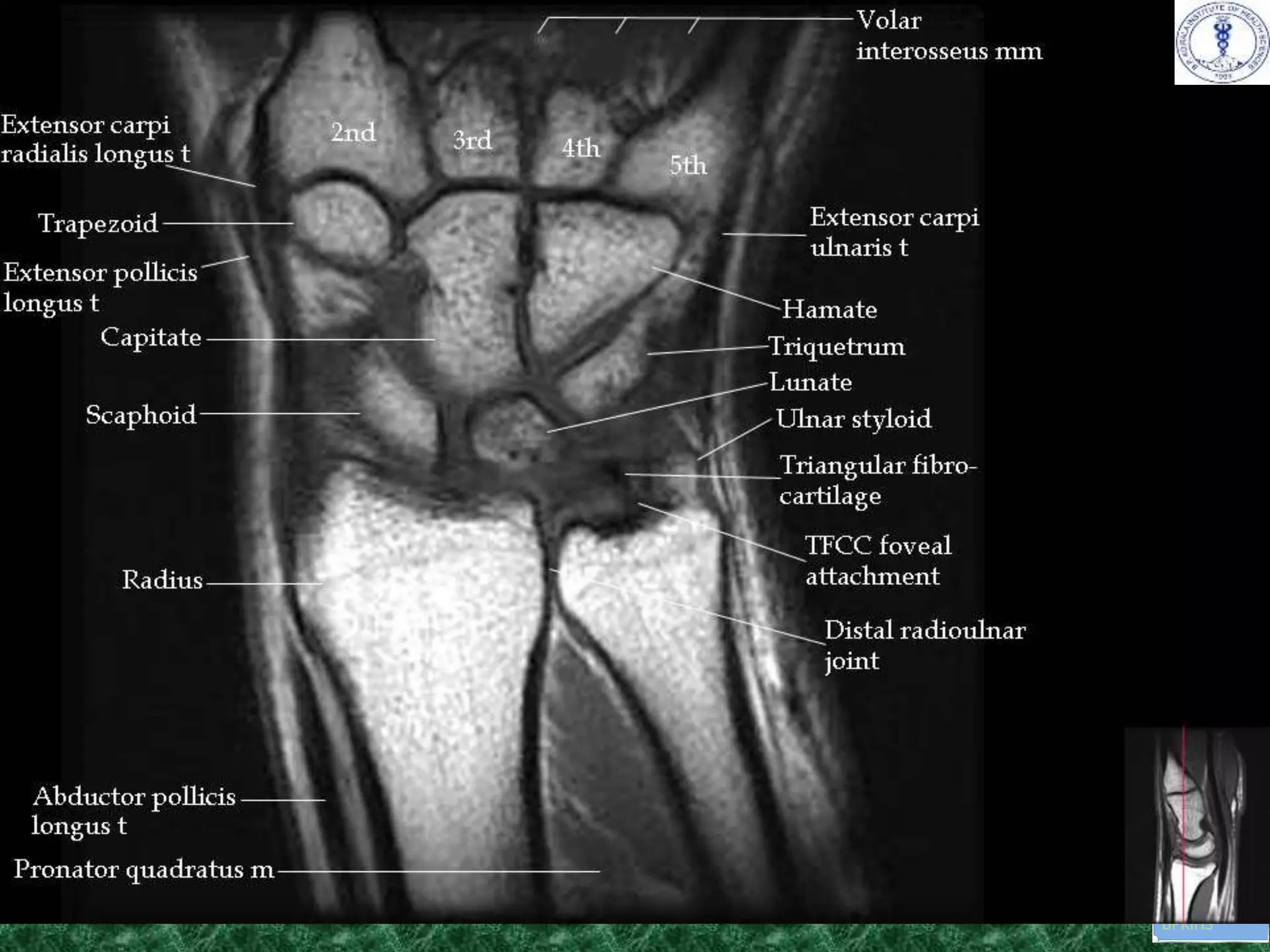 Anatomy and imaging of wrist joint (MRI AND XRAY) | PPTX