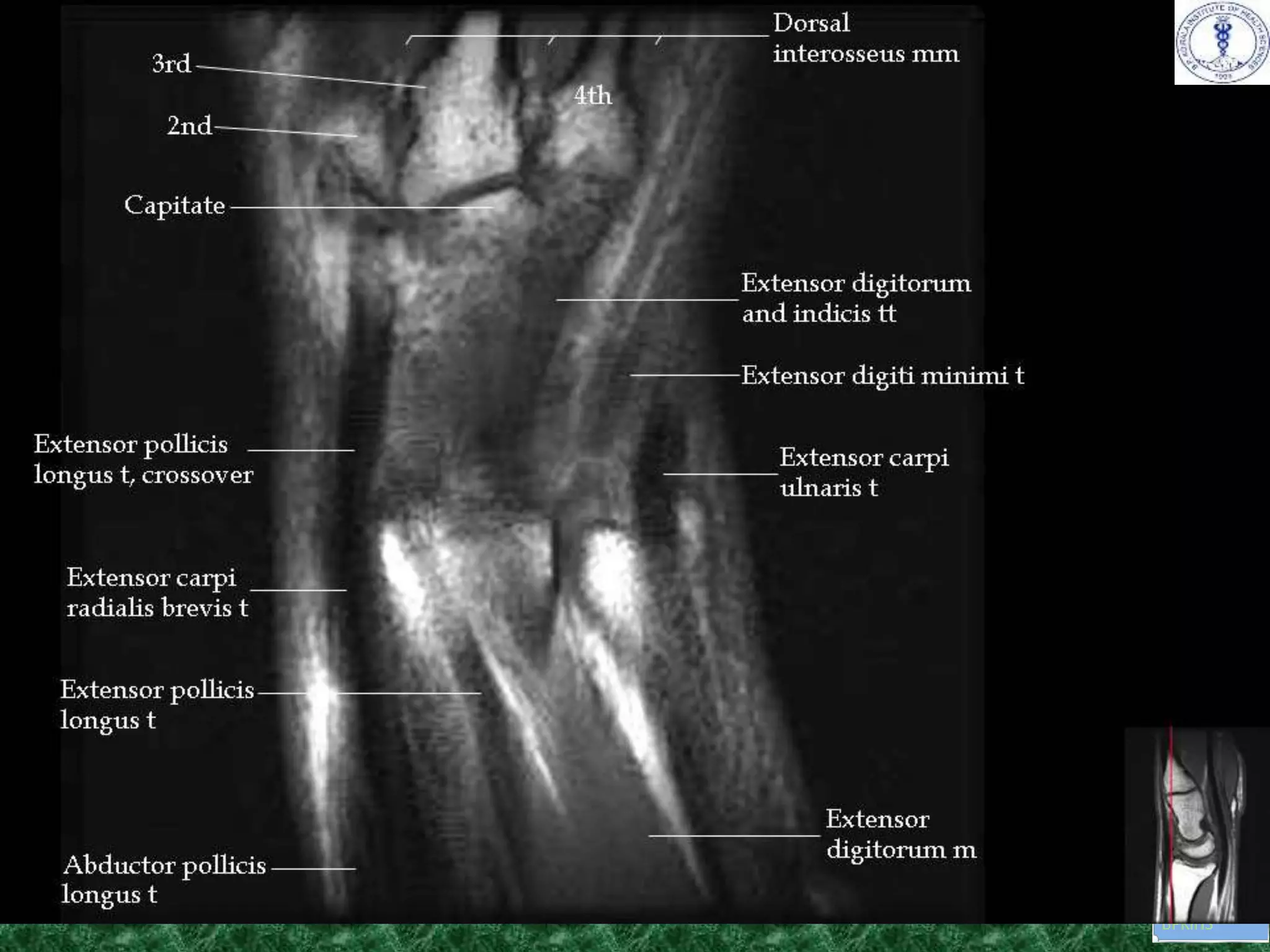 Anatomy and imaging of wrist joint (MRI AND XRAY) | PPTX