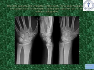 Anatomy and imaging of wrist joint (MRI AND XRAY) | PPTX