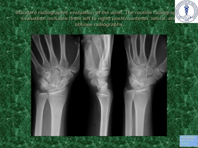Anatomy and imaging of wrist joint (MRI AND XRAY) | PPTX