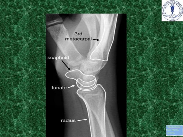 Anatomy and imaging of wrist joint (MRI AND XRAY) | PPTX