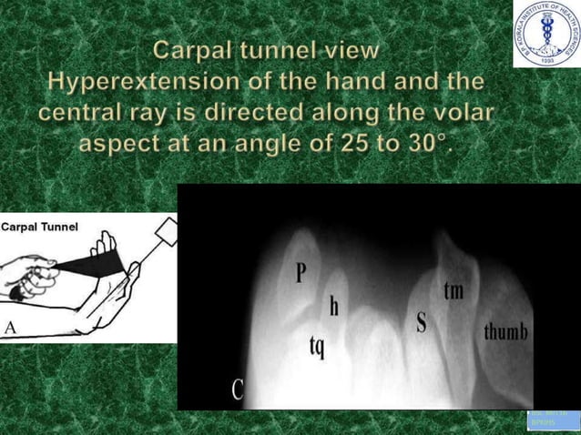 Anatomy and imaging of wrist joint (MRI AND XRAY) | PPTX