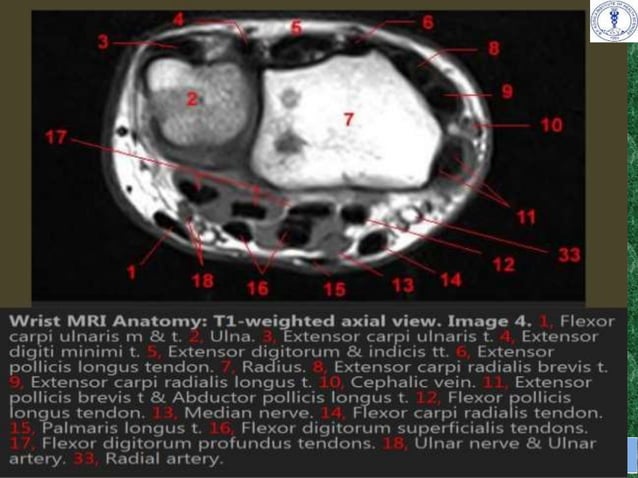 Anatomy and imaging of wrist joint (MRI AND XRAY) | PPTX