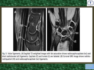 Anatomy and imaging of wrist joint (MRI AND XRAY) | PPTX