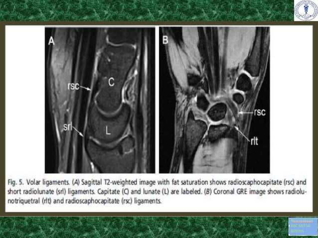 Anatomy and imaging of wrist joint (MRI AND XRAY) | PPTX
