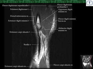 Anatomy and imaging of wrist joint (MRI AND XRAY) | PPTX