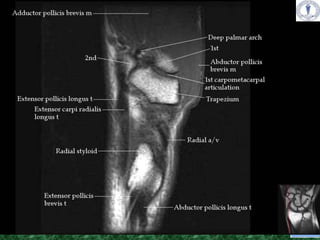 Anatomy and imaging of wrist joint (MRI AND XRAY) | PPTX