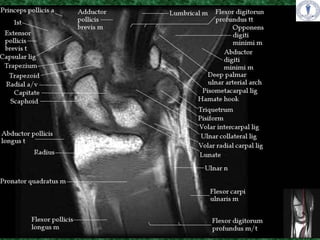 Anatomy and imaging of wrist joint (MRI AND XRAY) | PPTX