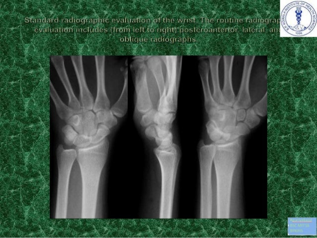 Anatomy and imaging of wrist joint (MRI AND XRAY)