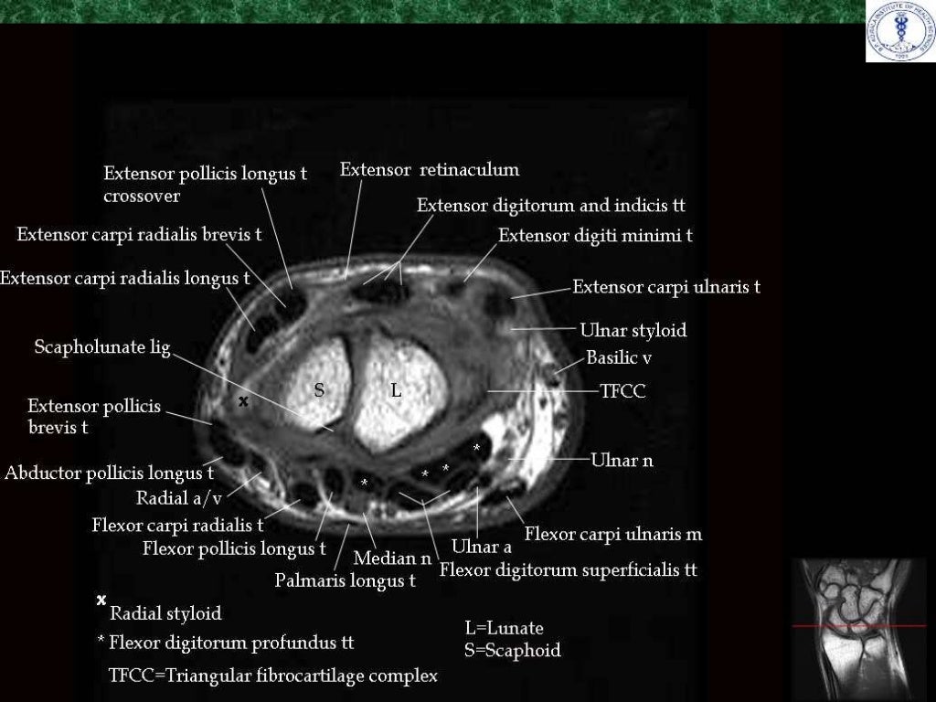 Anatomy and imaging of wrist joint (MRI AND XRAY)