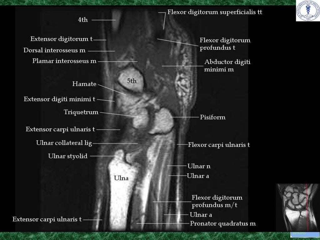 Anatomy and imaging of wrist joint (MRI AND XRAY)
