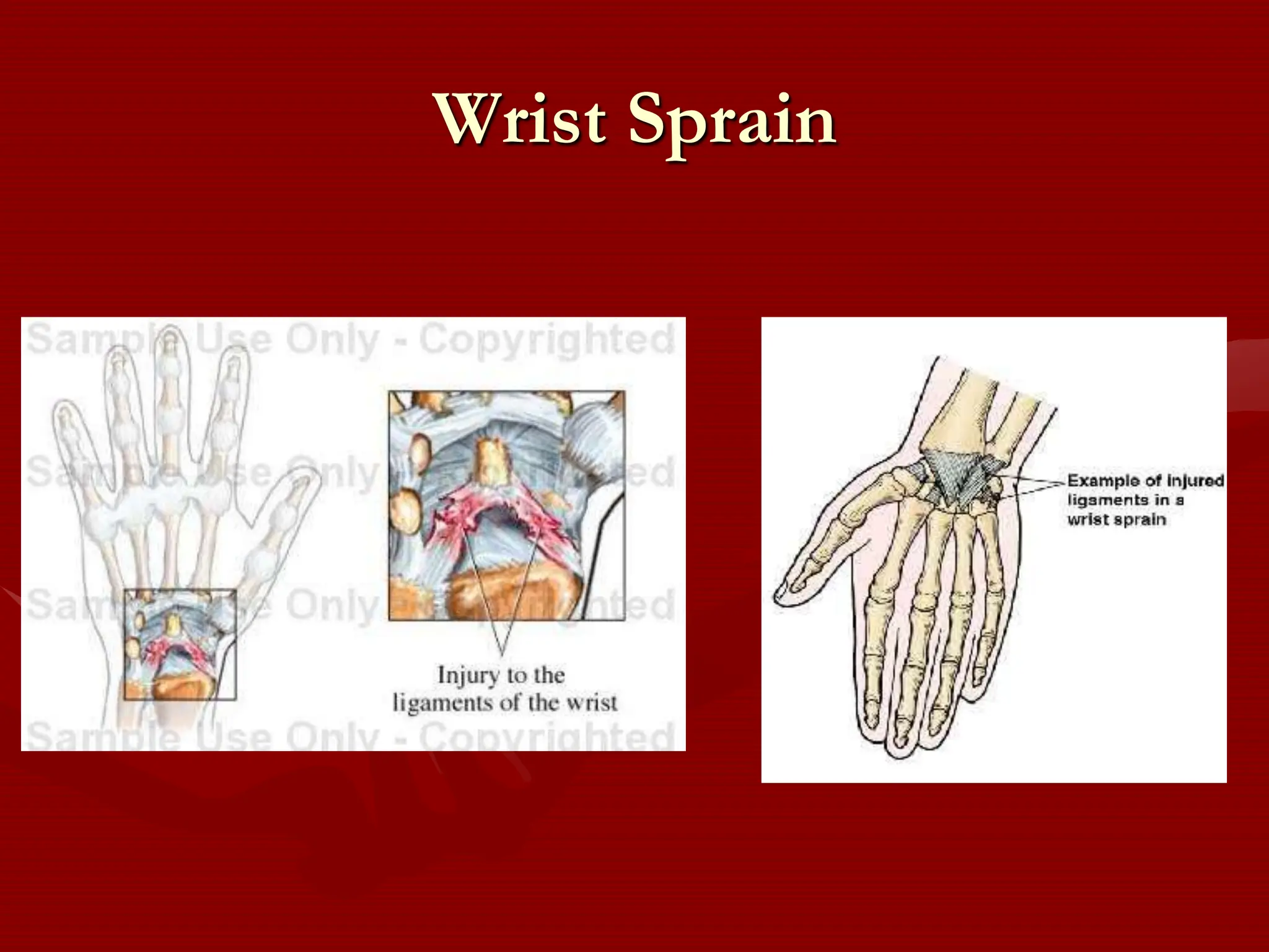Anatomy and Injuries to the Wrist and Hand.ppt