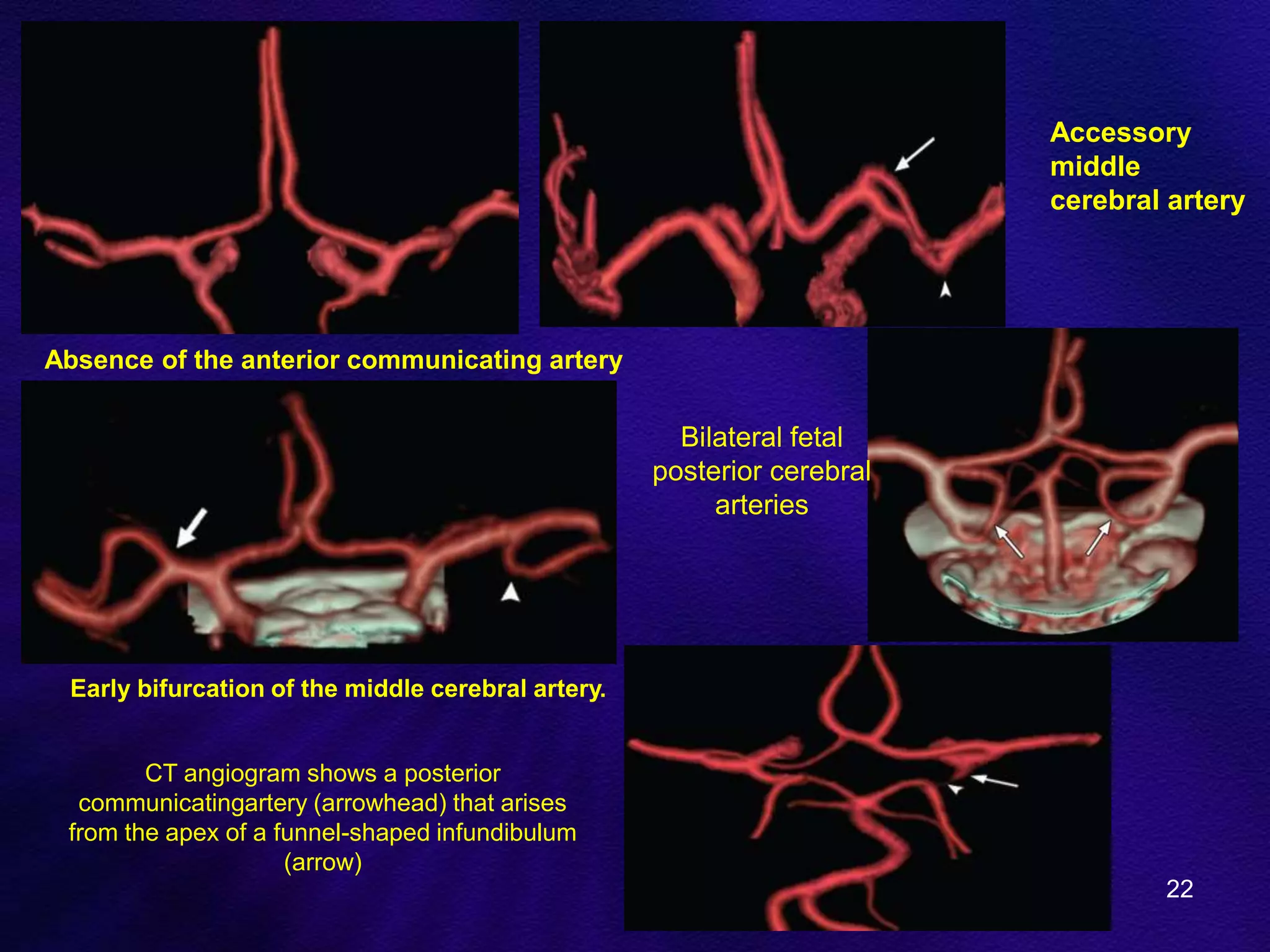 Anatomy and intervention in cerebral vasculature | PPTX