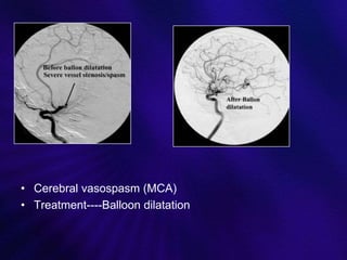 Anatomy and intervention in cerebral vasculature | PPTX