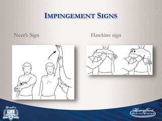 Neer And Hawkins Sign