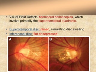 Anatomy and Physiology of Optic Nerve Dr.PrabhatDevkota.pptx
