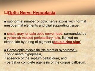 Anatomy and Physiology of Optic Nerve Dr.PrabhatDevkota.pptx