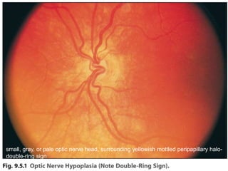 Anatomy and Physiology of Optic Nerve Dr.PrabhatDevkota.pptx