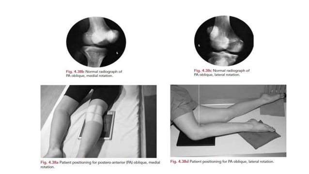 ANATOMY AND POSITIONING OF KNEE.pptx | Death, Injury, or Military ...
