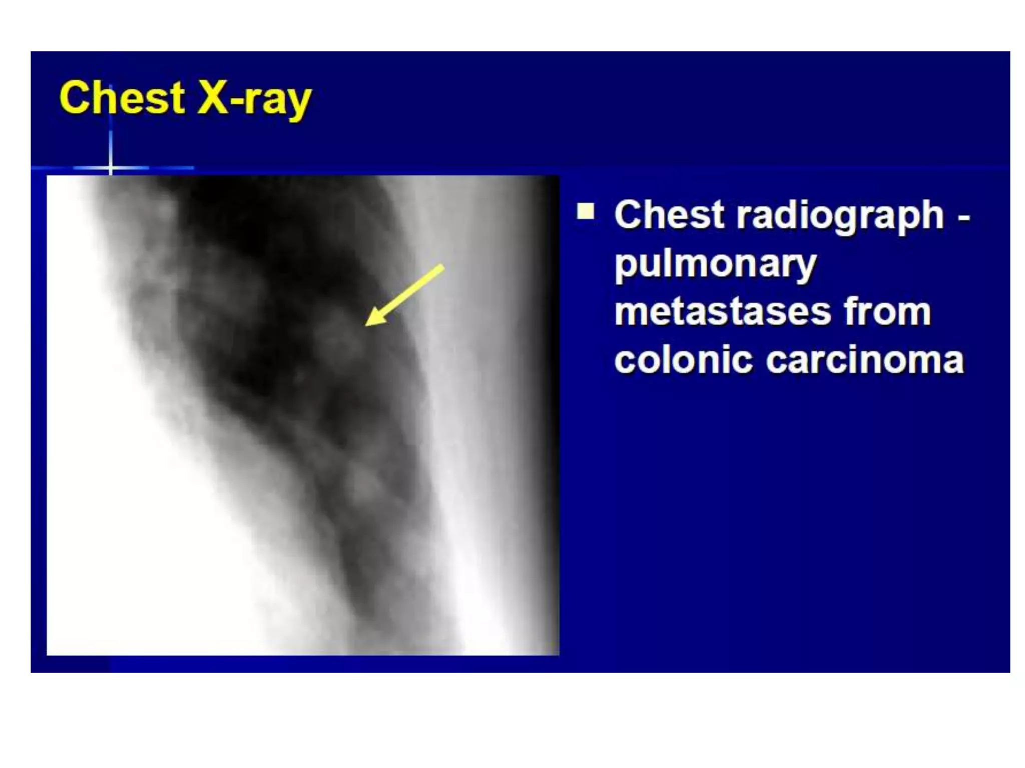Anatomy and staging of ca colon | PPTX