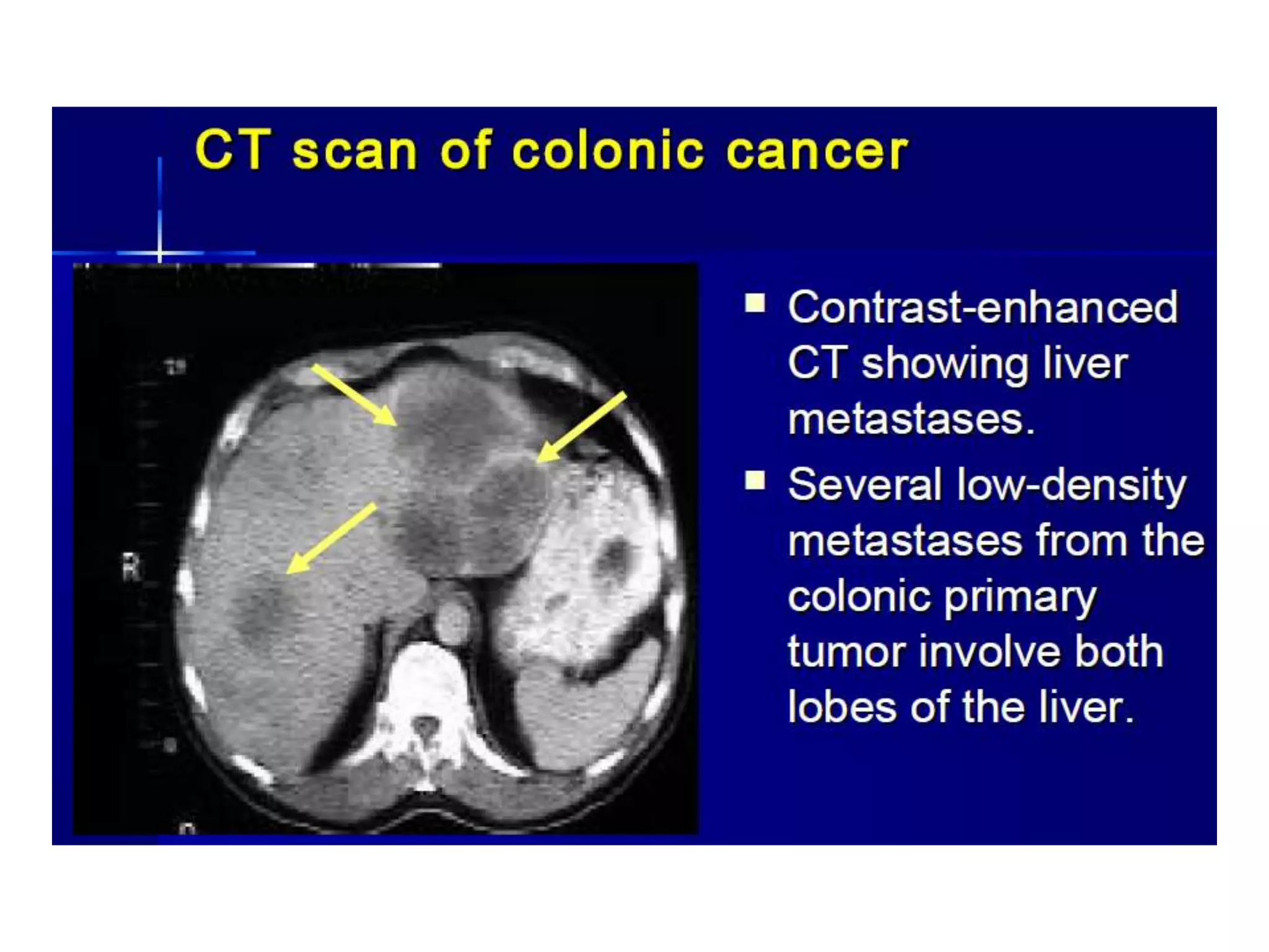Anatomy and staging of ca colon | PPTX