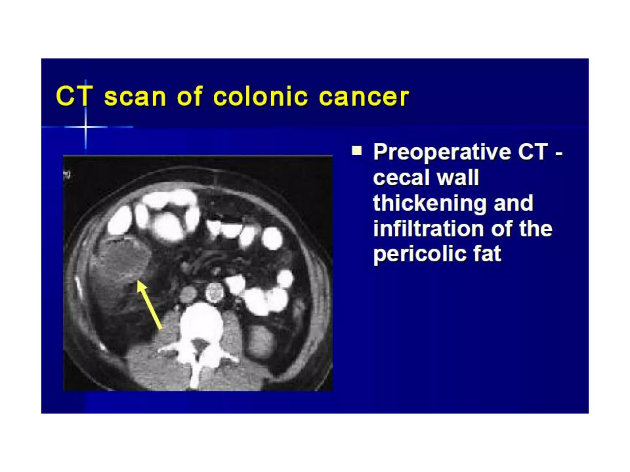 Anatomy and staging of ca colon | PPTX