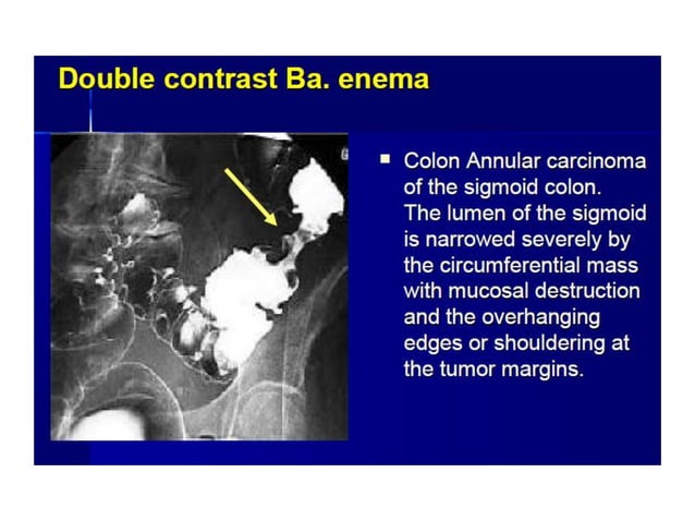 Anatomy and staging of ca colon | PPTX