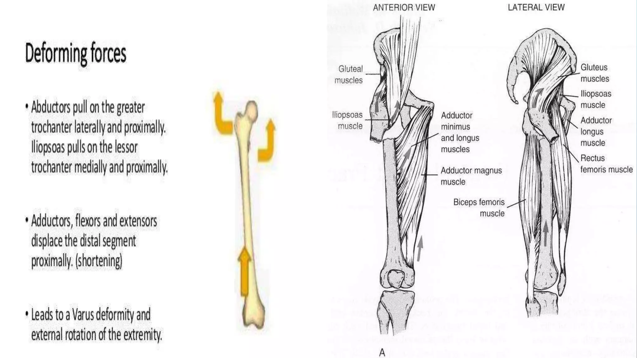 Anatomy,Biomechanics & surgical approaches of proximal femur | PPTX