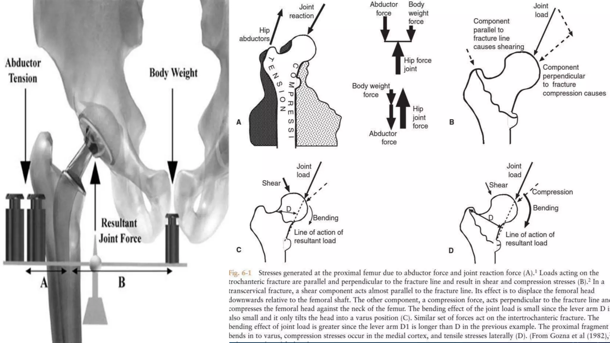 Anatomy,Biomechanics & surgical approaches of proximal femur | PPTX