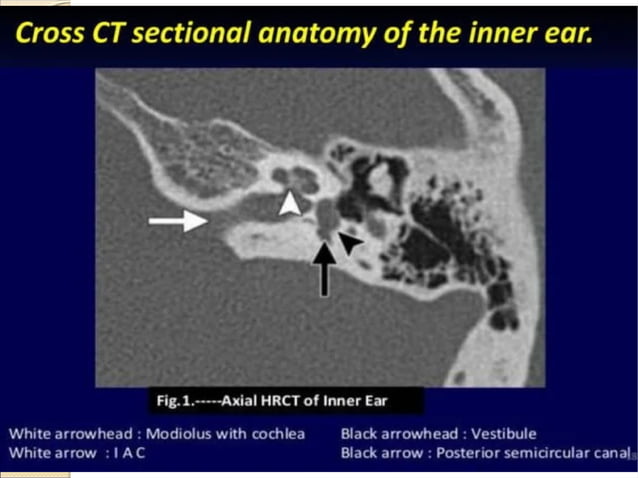 anatomy congenital anomalies inner earrr.pptx
