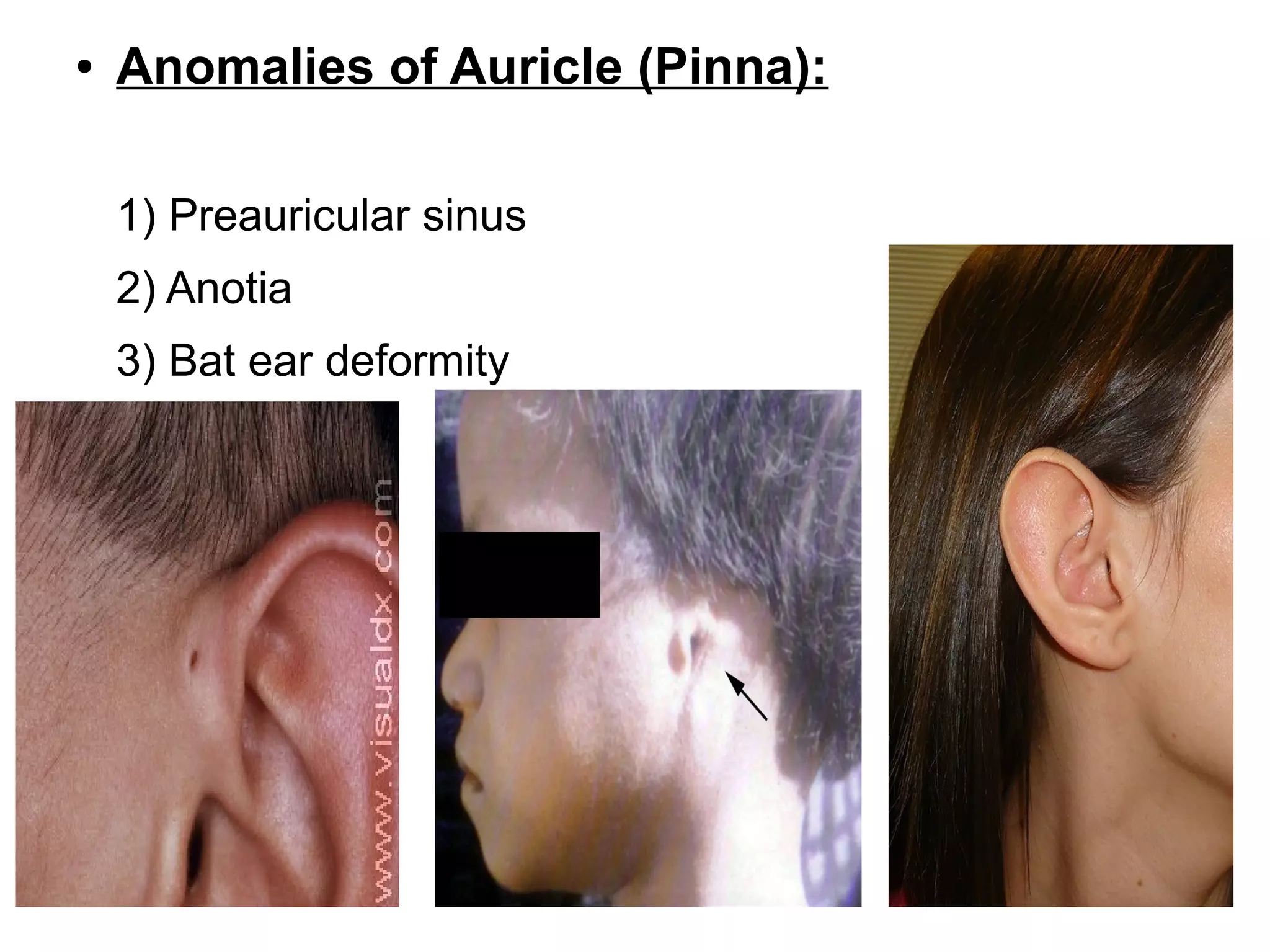 Anatomy & embryology ext ear & middle ear | ODP